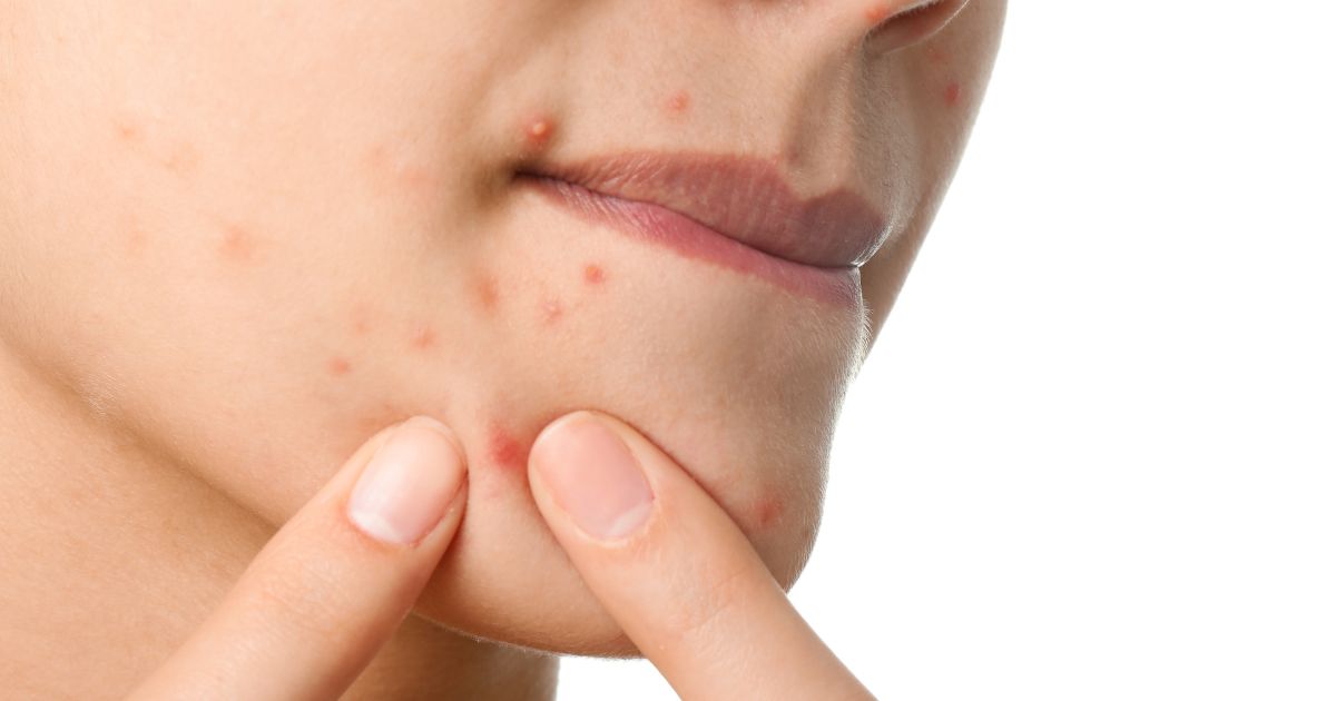 Tratamiento para el acné | Biosany